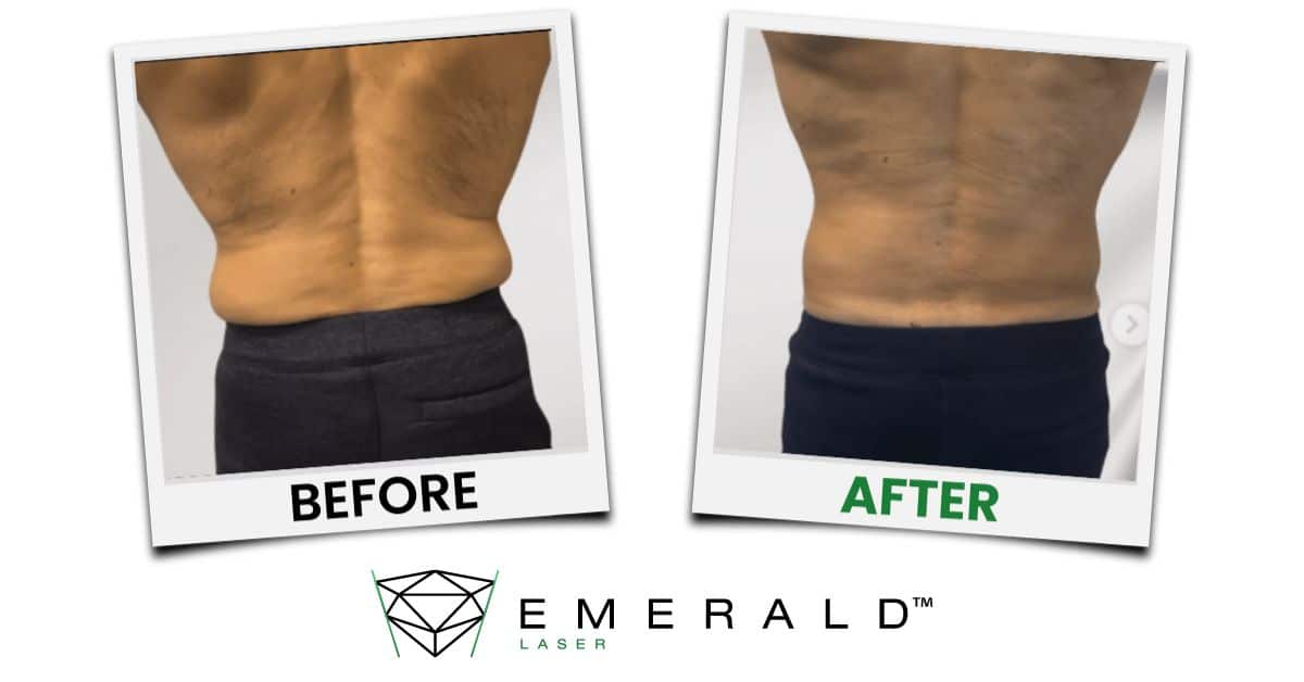 Laser Lipo for Hips & Love Handles - Emerald Laser