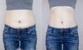 Micro Laser Liposuction vs. Non-Invasive Laser Fat Removal: A Comparison
